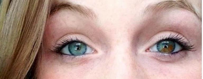 Heterokromi-lumineyes-mylumineyesh300 | My Lumineyes – Laser Eye Color ...