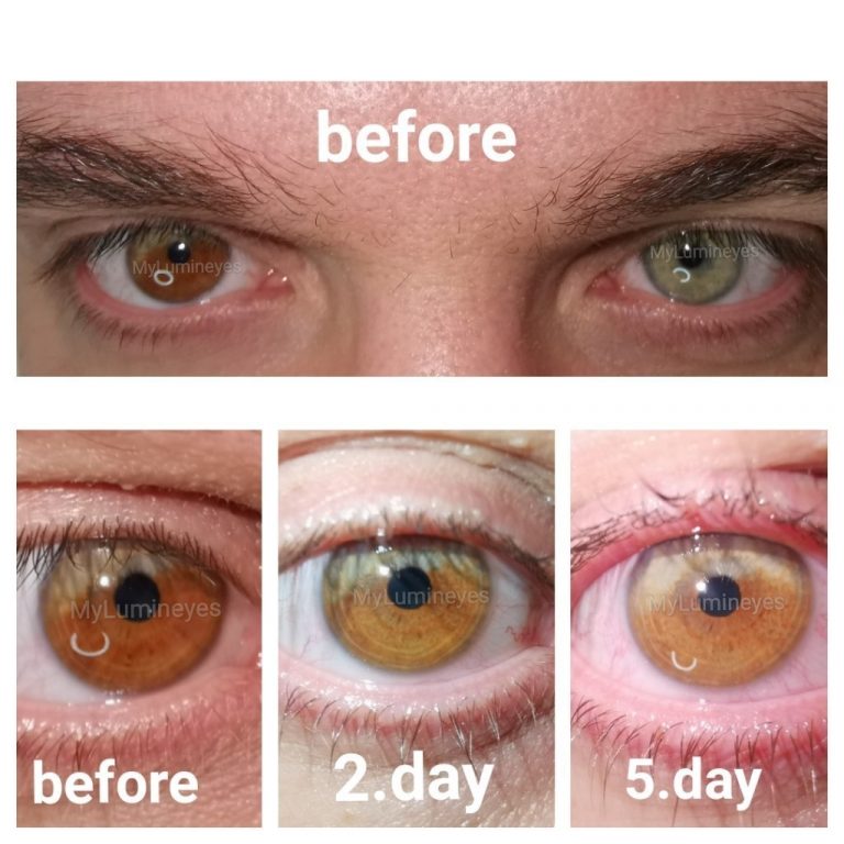 Pigment Dispersion Syndrome And Heterochromia Laser Theraphy