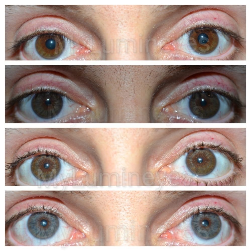 Cirurgia Para Mudança Permanente Da Cor Dos Olhos