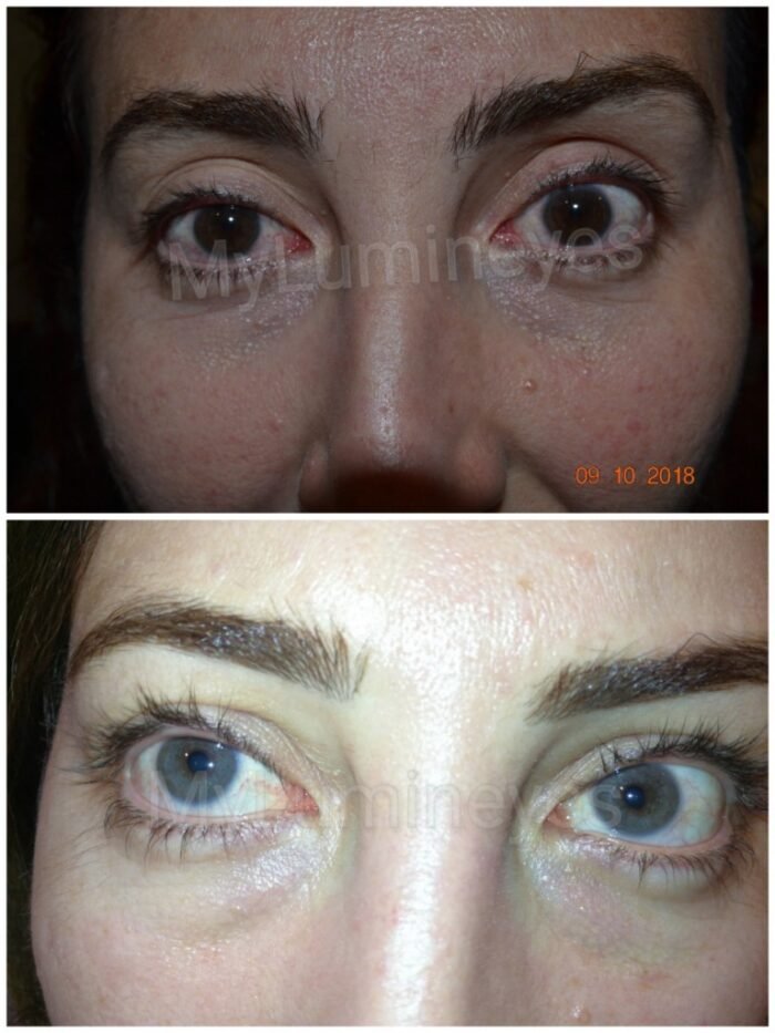 Eye color change surgery laser Eye Color Change Surgery before and after