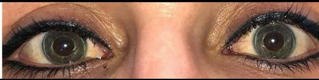 Keratopigmentation Cost Corneal Tattooing For Eye Color Change Keratopigmentation Cost Corneal Tattooing For Eye Color Change